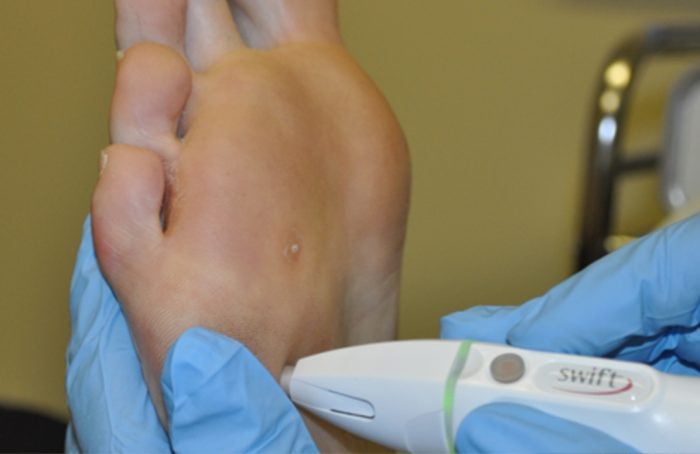 warts - Victor Feet First
